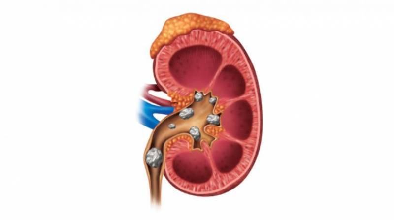 استعمال اكياس ستروسيد ماغنسيوم بلس لمنع تكون الحصوات - موقع المعلومات